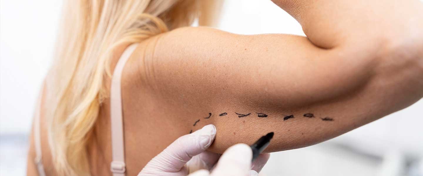 Plasma Pen Body - Kirstin Abrook Skin Clinic